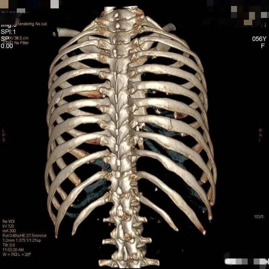 胸部外伤病人CT扫描后做三维重建的意义-搜狐大视野-搜狐新闻