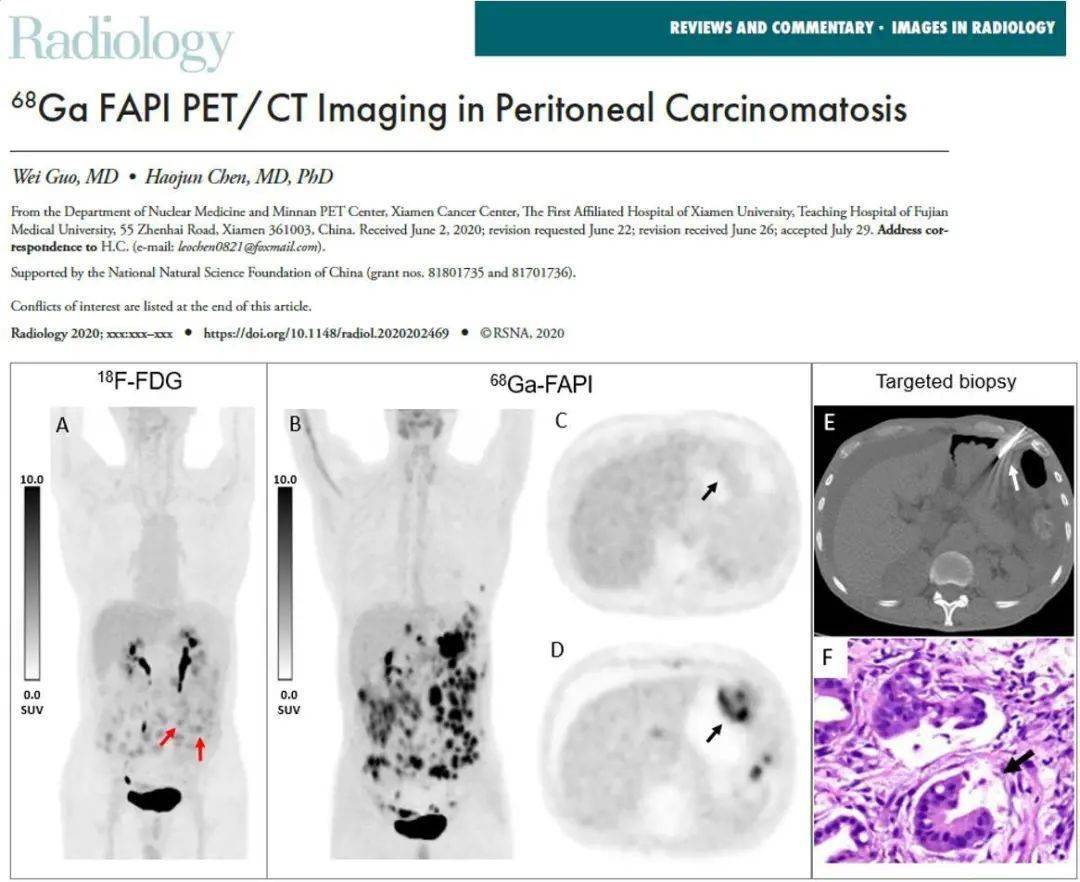 【学术】厦大一院核医学科荣登Radiology | PET示踪剂68Ga-FAPI_肿瘤