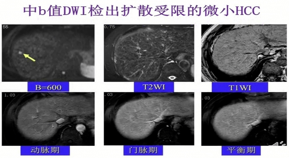 DWI序列上不同b值对于显示病灶的意义-搜狐大视野-搜狐新闻