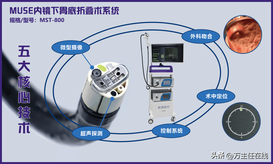 万荣教授通过新一代国产MUSE系统首创手术祛除食管反流病痛_患者_内窥镜_治疗