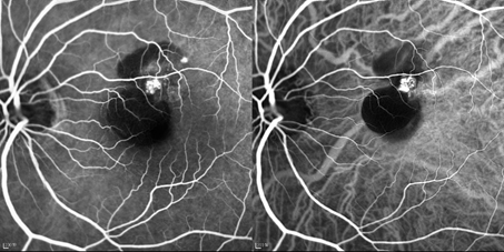 医讯‖我院眼科开展FFA与ICGA同步造影技术_病变