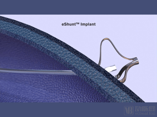 脑积水治疗设备的突破创新，帮助CereVasc斩获4390万美元A轮融资【海外案例】_eShunt