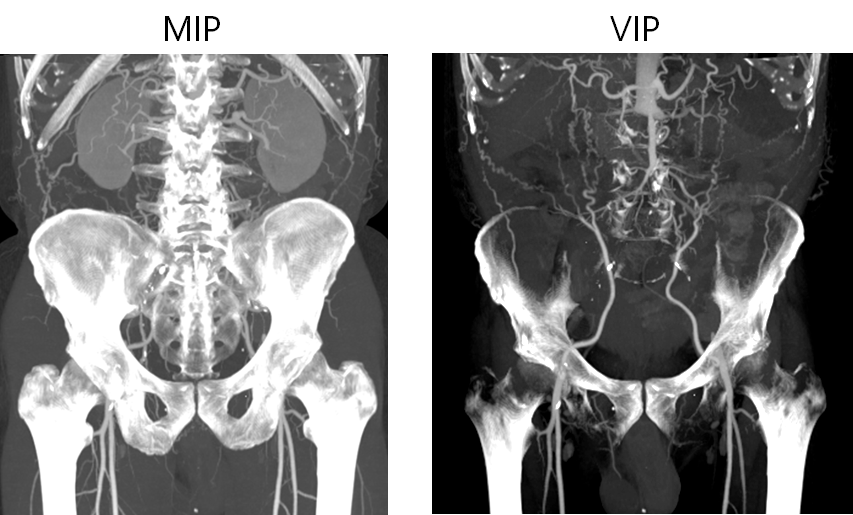 CT后处理技巧——MIP与VIP_显示