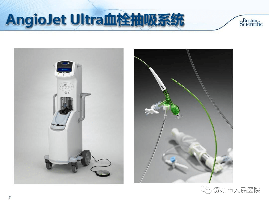 【填补技术空白】贺州市人民医院介入科率先开展AngioJet血栓抽吸清除技术_下肢