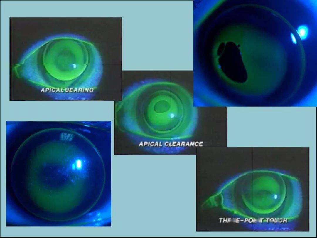 【眼视光】 RGP临床运用-搜狐大视野-搜狐新闻