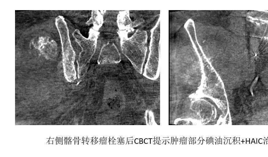 可调控微导管 | 联合D-TACE +HAIC 为91岁肝癌骨转移老人成功介入手术_动脉