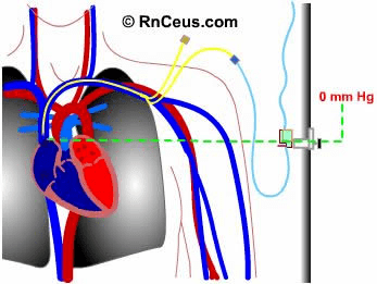 CVP可以为负数吗？——那些关于CVP你不知道的事_测量