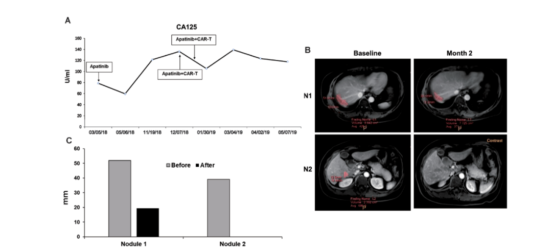 重磅！国际首个自分泌PD-1 CAR-T细胞联合疗法临床实验数据公布！12年磨一剑，剑指实体瘤！丨医麦猛爆料_治疗