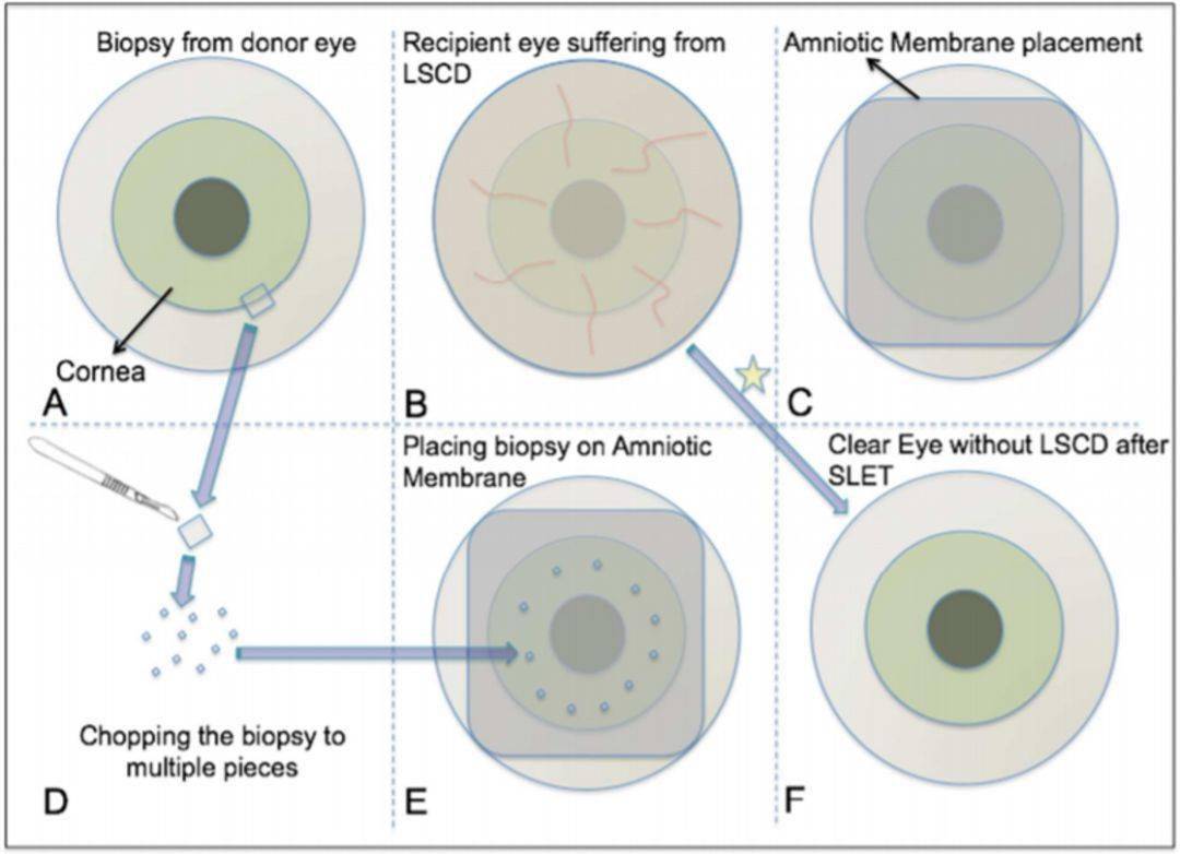 开启角膜患者光明之窗的干细胞产品：HOLOCLAR_移植