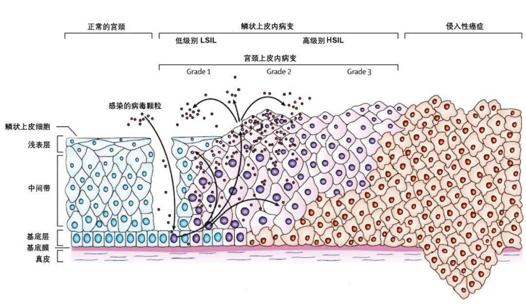 突破进展全癌标志物来了,消除宫颈癌我们在路上肿瘤