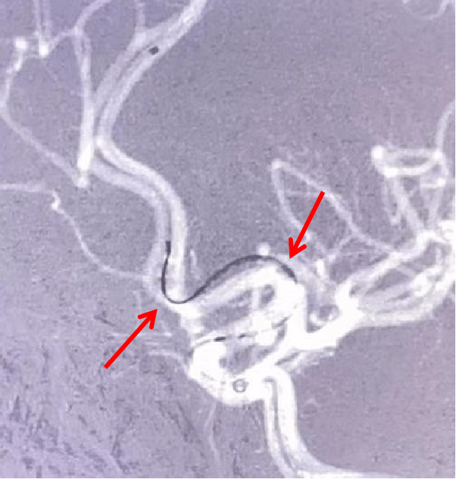 送无阻、顺必达—Phenom™ 27微导管在前循环远端血管中的应用_支架_Flex_血流