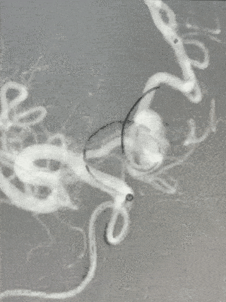 送无阻、顺必达—Phenom™ 27微导管在前循环远端血管中的应用_支架_Flex_血流