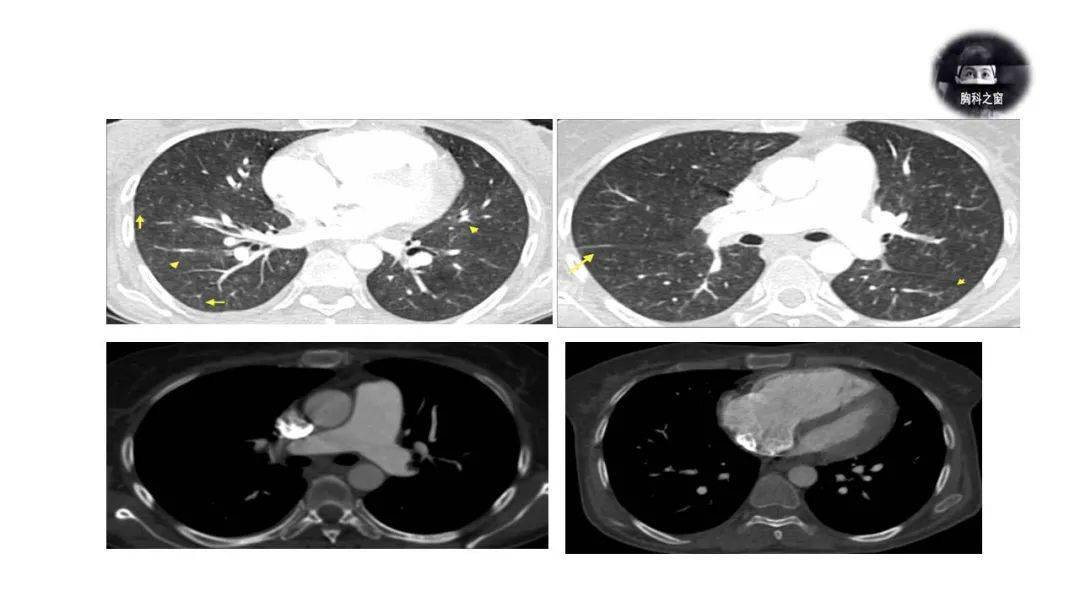 肺肿瘤性血栓性微血管病（PTTM）_患者_肺动脉_栓塞