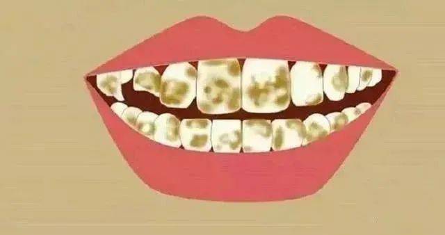 牙齿为什么会变黄？常用的美白方式了解一下斑牙冷光牙釉质