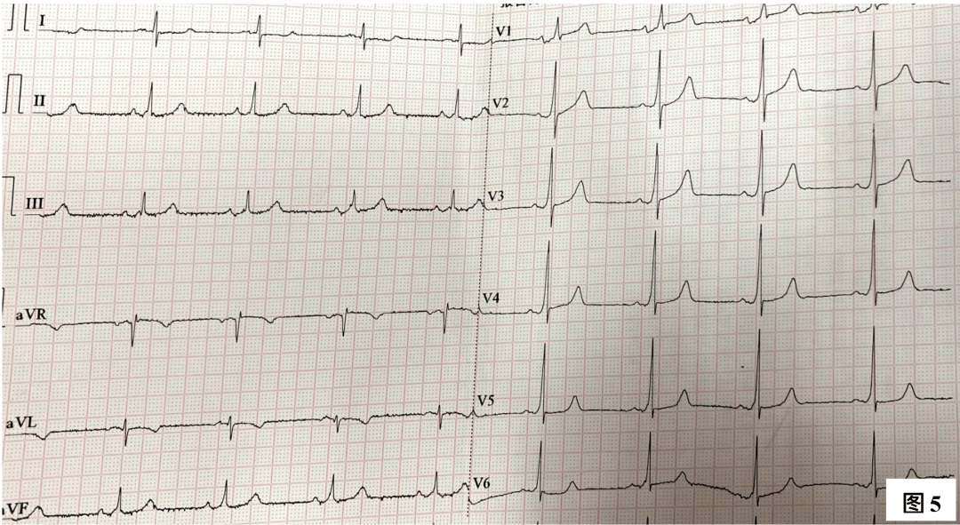 主任提问：宽 QRS 心动过速的 6 种鉴别方法，都是啥？_心室_心电图_患者