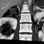 肺淋巴管肌瘤病影像诊断_弥漫性_医学界_Cornog