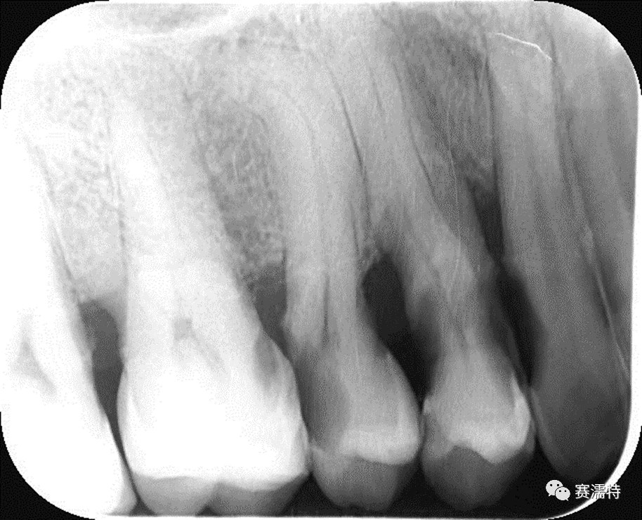 中国锶·C-Root SP：让根管充填如此简单！_口腔_效果_硅酸盐