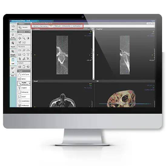 INVIVO5口腔种植正畸拍摄软件安装教学_Invivo_进行_Table
