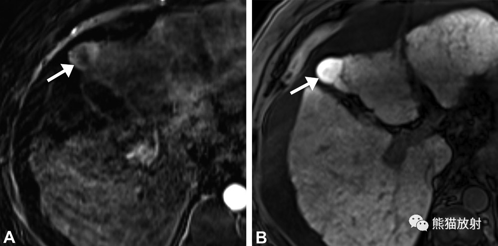 FNH及FNH样病变丨影像表现_信号_肝脏_中央
