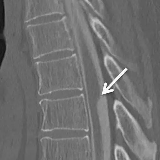 手术刀征：背侧蛛网膜网带_the_cord_of