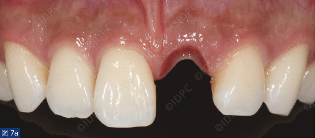 【精选案例】CAD/CAM愈合基台及美学区引导手术实现软组织轮廓保存：病例报告（美）_种植_牙龈