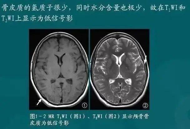 头颅 MRI 不会看？DWI、T1、T2......这篇讲清楚了！_成像_信号_序列