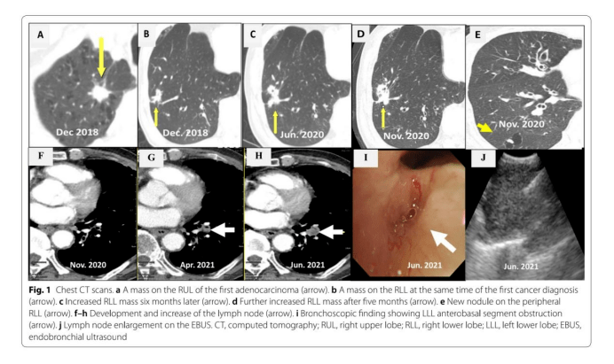 三种不同的肺癌亚型出现在一个患者身上，这究竟是怎么回事？_右肺_进行_肿块