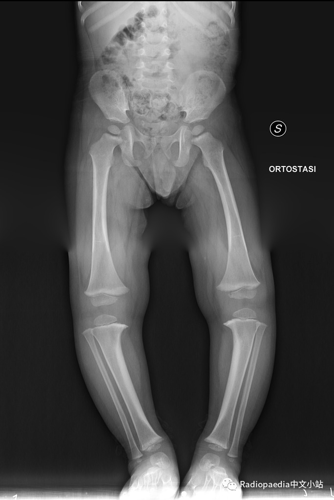 少见但典型：Blount病_胫骨_进行性_治疗