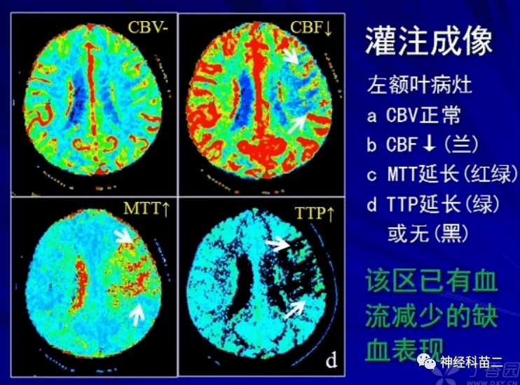 脑CT灌注成像-CTP，如何解读？_时间_局部_变化