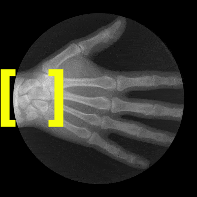 TFCC损伤的检查、评估和康复训练（收藏）_手腕_三角_韧带