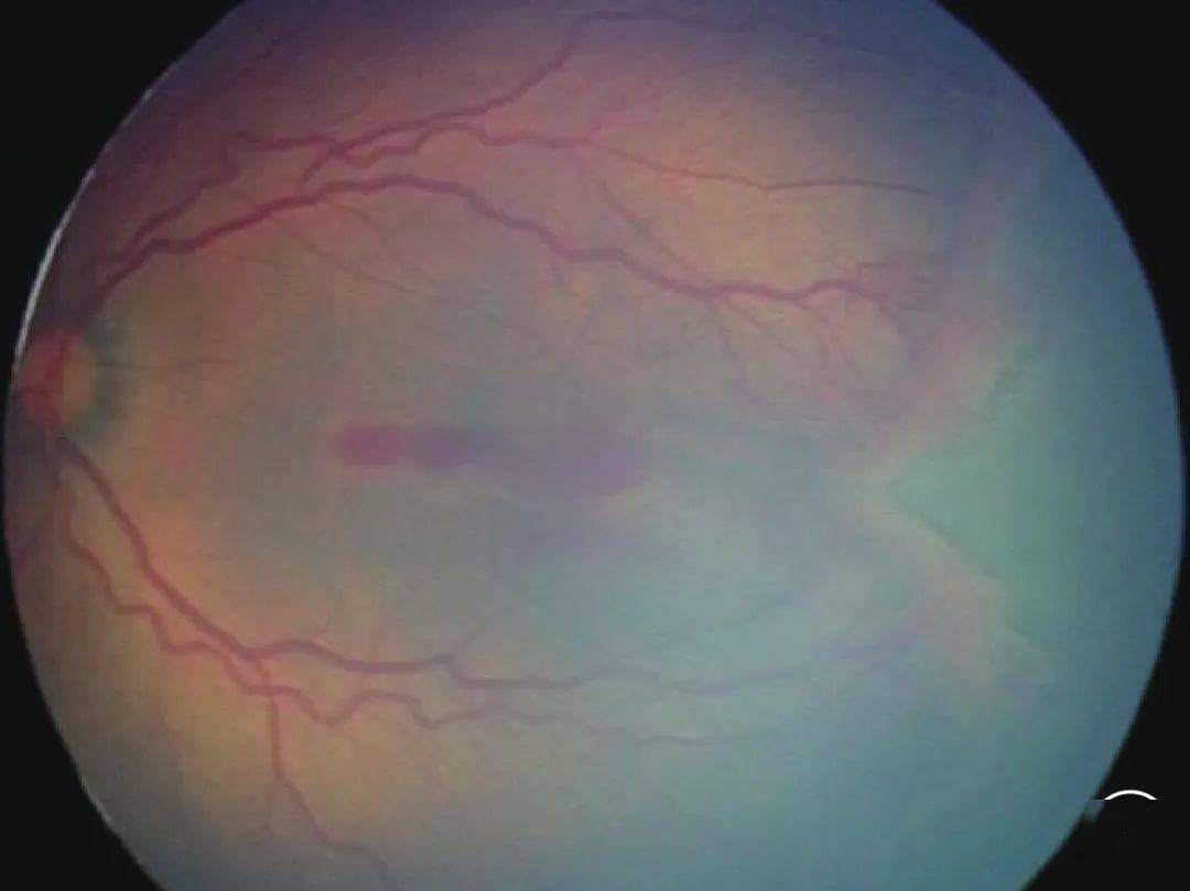 中国早产儿视网膜病变分类和治疗专家共识（2023年）_眼底_新生儿_血管